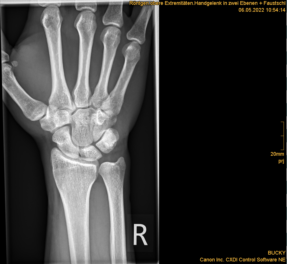 How bad is my positive ulnar variance? : r/AskDocs